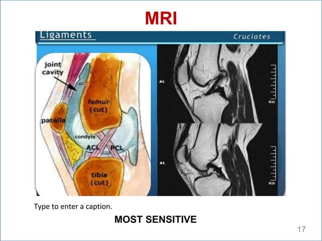 PCL POSTERIOR CRUCIATE LIGAMENT OF KNEE JOINT SPORTS INJURY: HOW TO ...