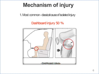 PCL POSTERIOR CRUCIATE LIGAMENT OF KNEE JOINT SPORTS INJURY: HOW TO ...