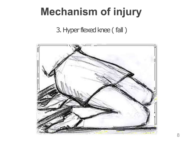 PCL POSTERIOR CRUCIATE LIGAMENT OF KNEE JOINT SPORTS INJURY: HOW TO ...