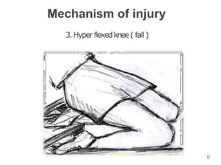 Pcl Mechanism Of Injury