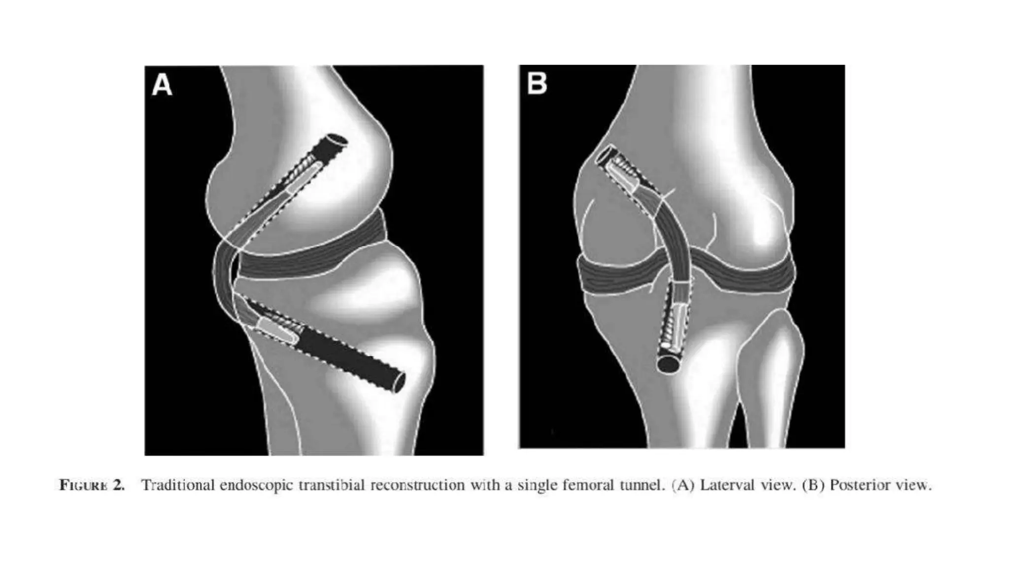 PCL injuriessss,mechanism,diagnosis and treatment.pptx