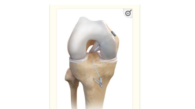 PCL injuriessss,mechanism,diagnosis and treatment.pptx