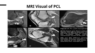 Posterior Cruciate Ligament- Surgical Anatomy | PPTX