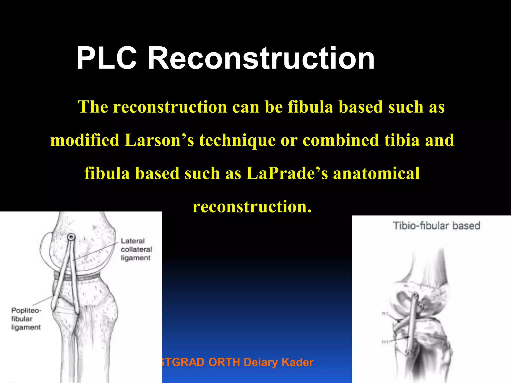PCL, PLC, Knee Dislocation | PPTX