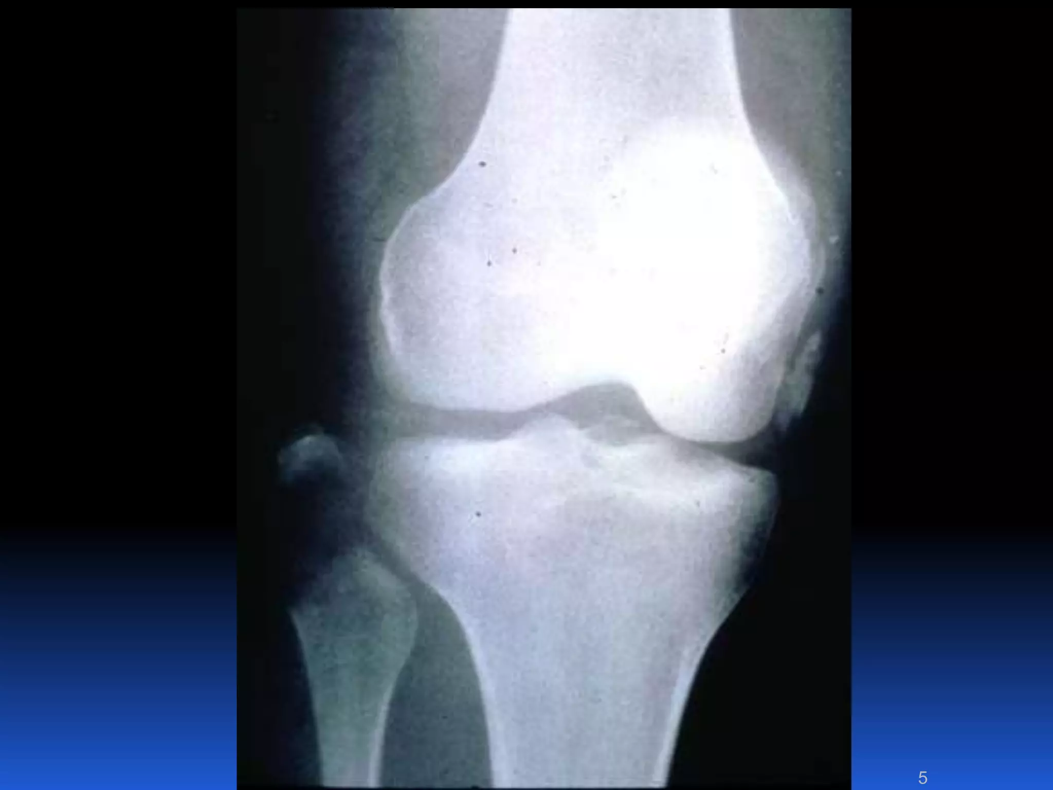 PCL, PLC, Knee Dislocation | PPTX
