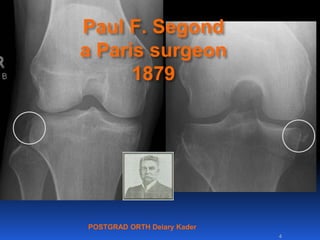 PCL, PLC, Knee Dislocation | PPTX