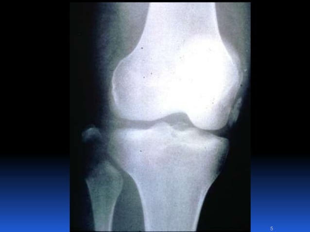 PCL, PLC, Knee Dislocation | PPTX | Death, Injury, or Military Conflict ...