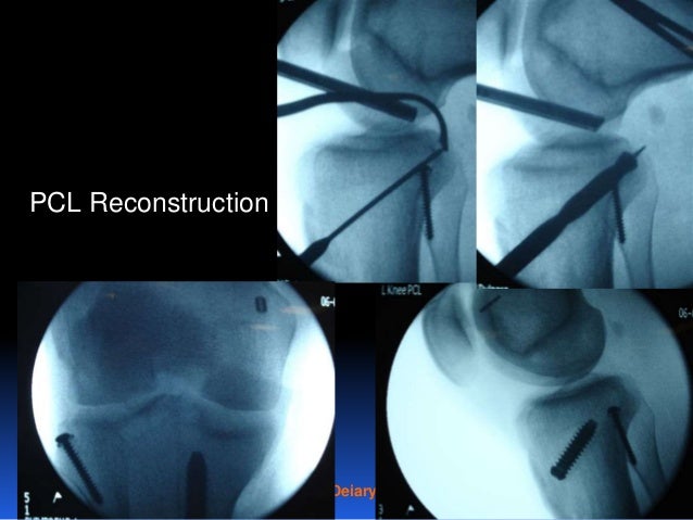 PCL, PLC, Knee Dislocation