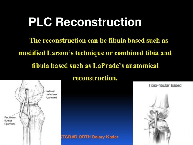 PCL, PLC, Knee Dislocation