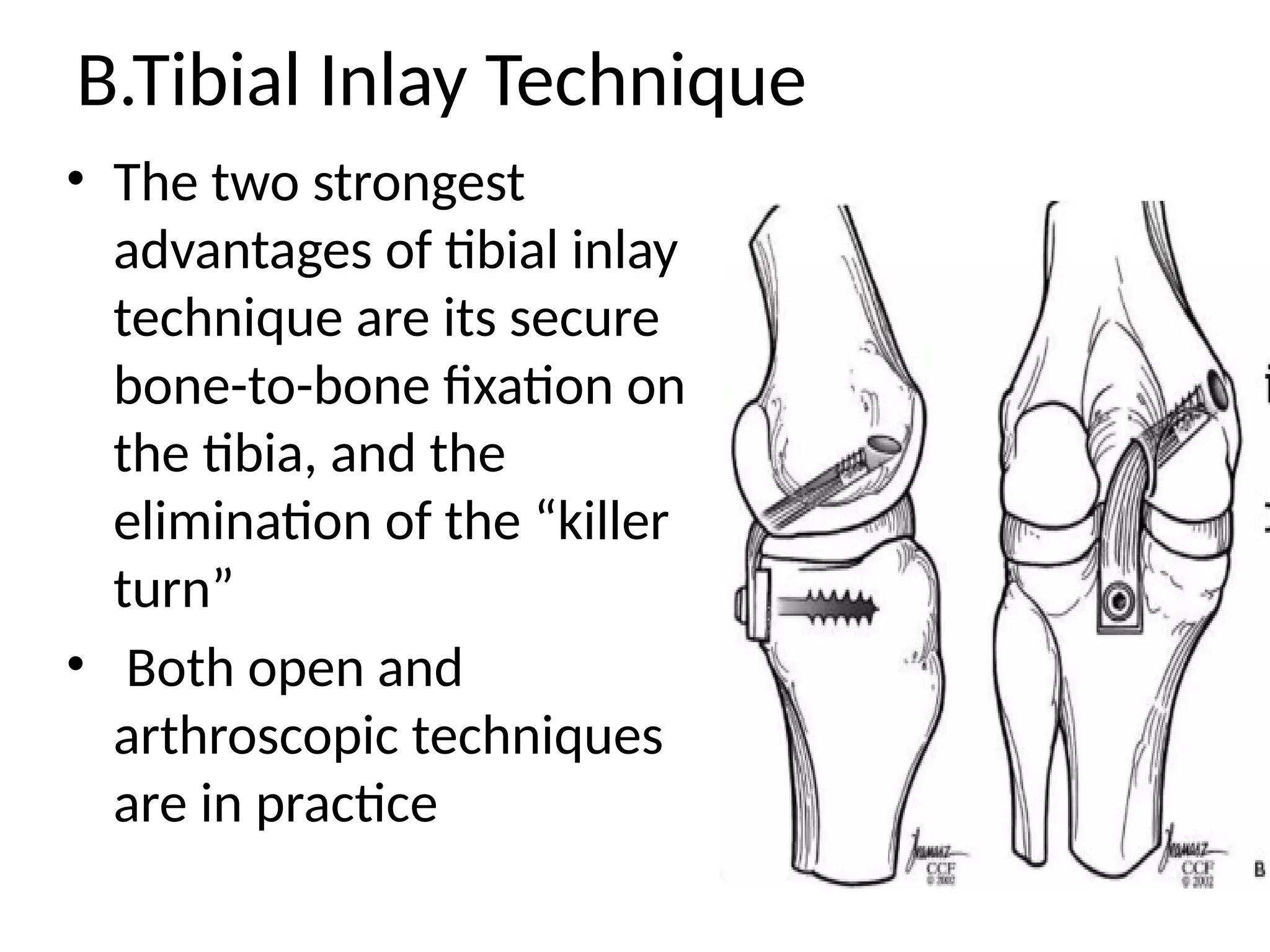 posterior crciate ligament presentation1.pptx