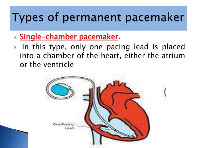 Pacemaker | PPTX | Heart and Cardiovascular Diseases | Diseases and ...