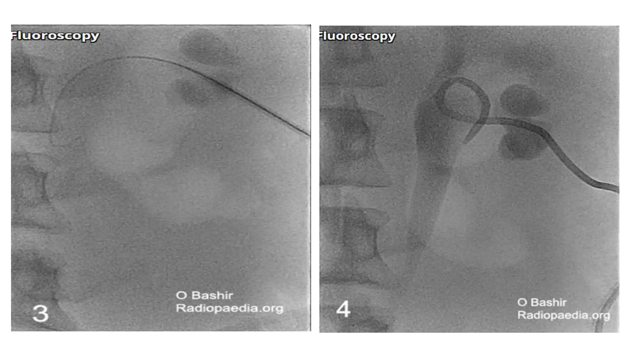 PCN Intervention Radiology.pptx