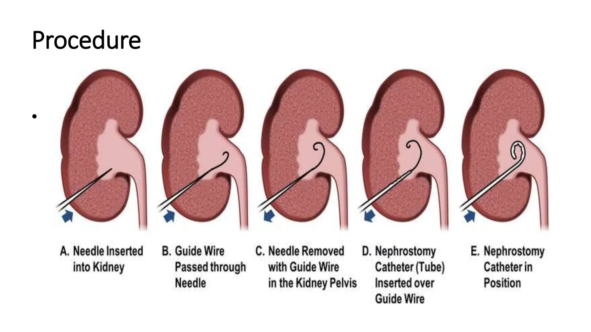 PCN Intervention Radiology.pptx