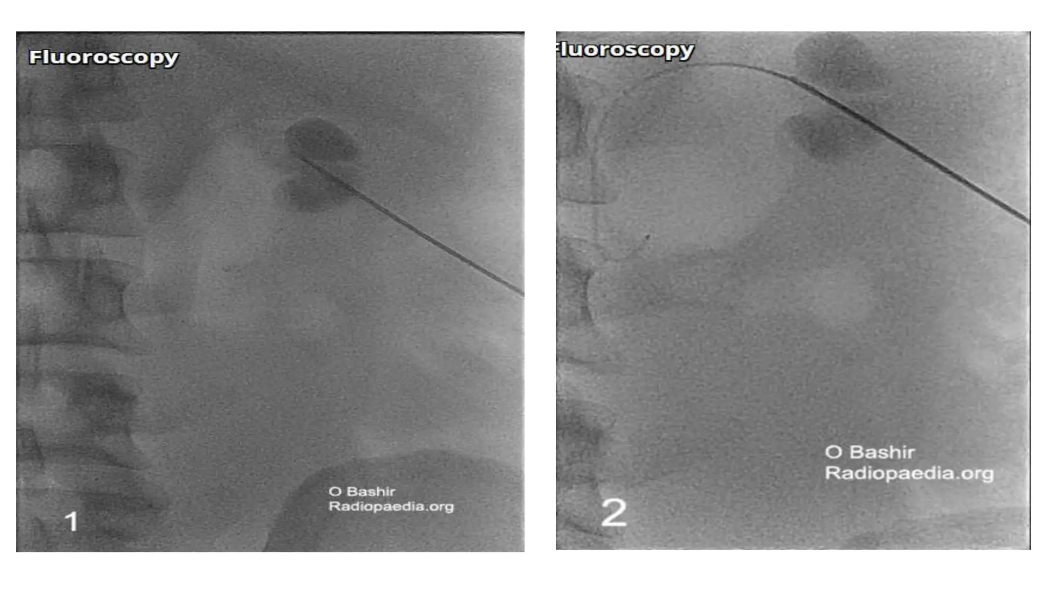 PCN Intervention Radiology.pptx