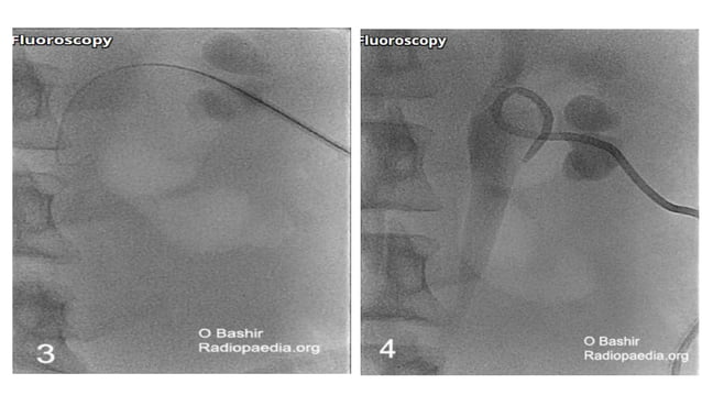 PCN Intervention Radiology.pptx