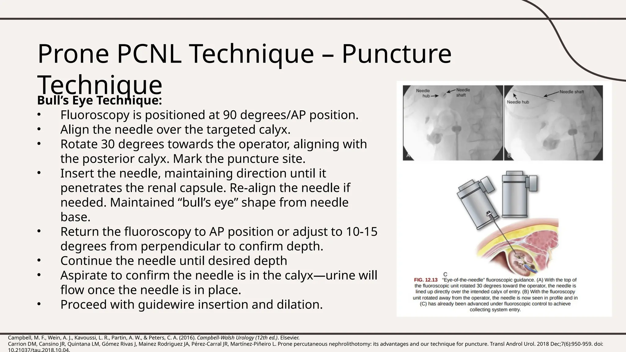 PCNL puncture Technique. Describe variation of puncture | PPTX