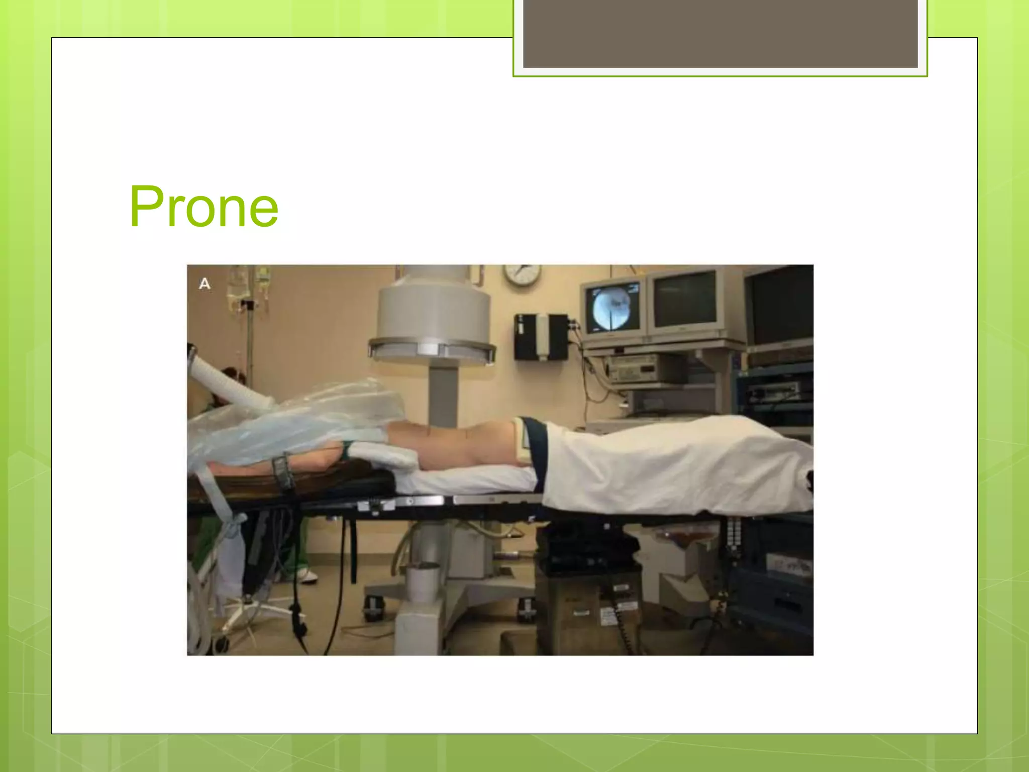 prone versus supine pcnl | PPTX