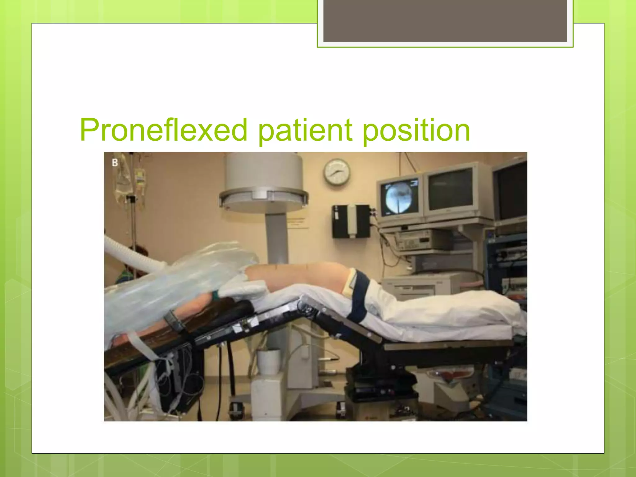 prone versus supine pcnl | PPTX
