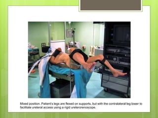 prone versus supine pcnl | PPTX