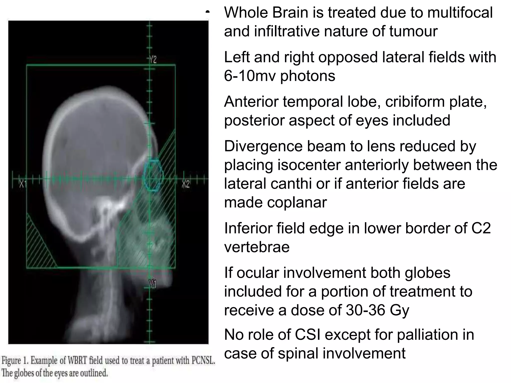 primary CNS lymphoma | PPTX