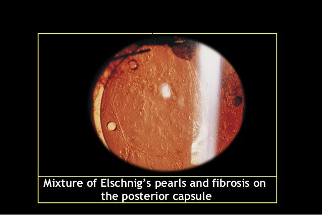 Pco - by dr. Heba mahmoud (M D)