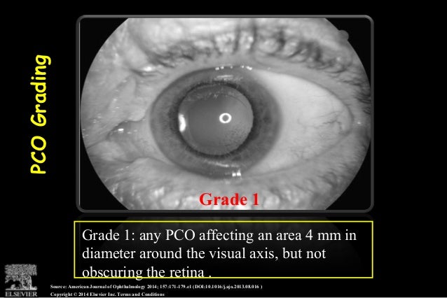Pco - by dr. Heba mahmoud (M D)