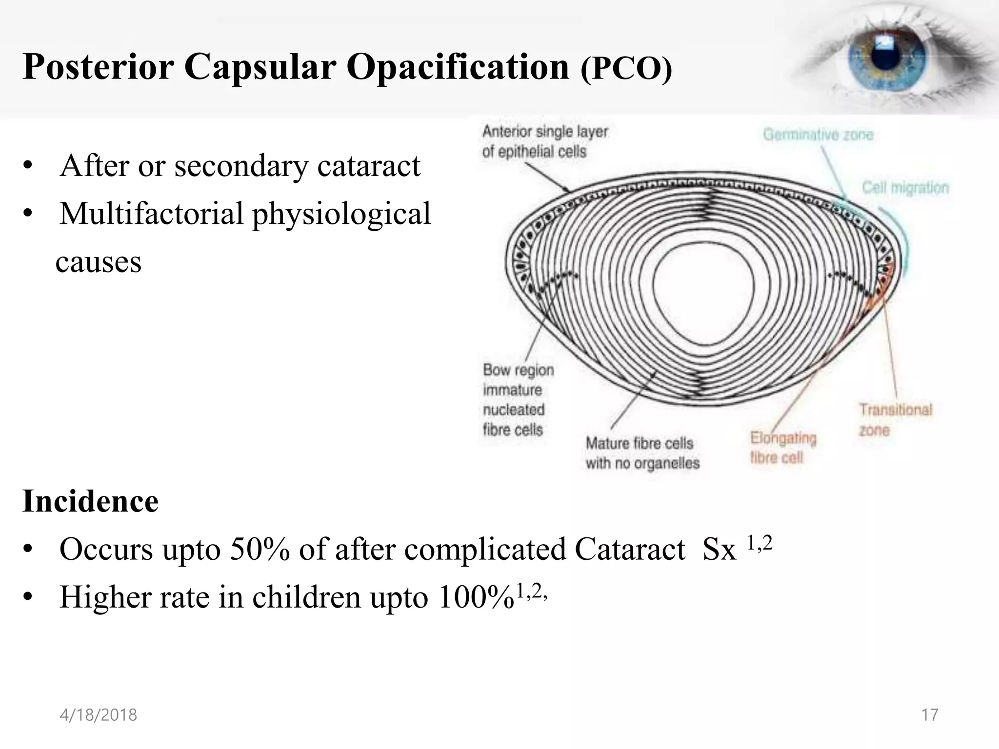 Posterior capsular opacification | PPTX