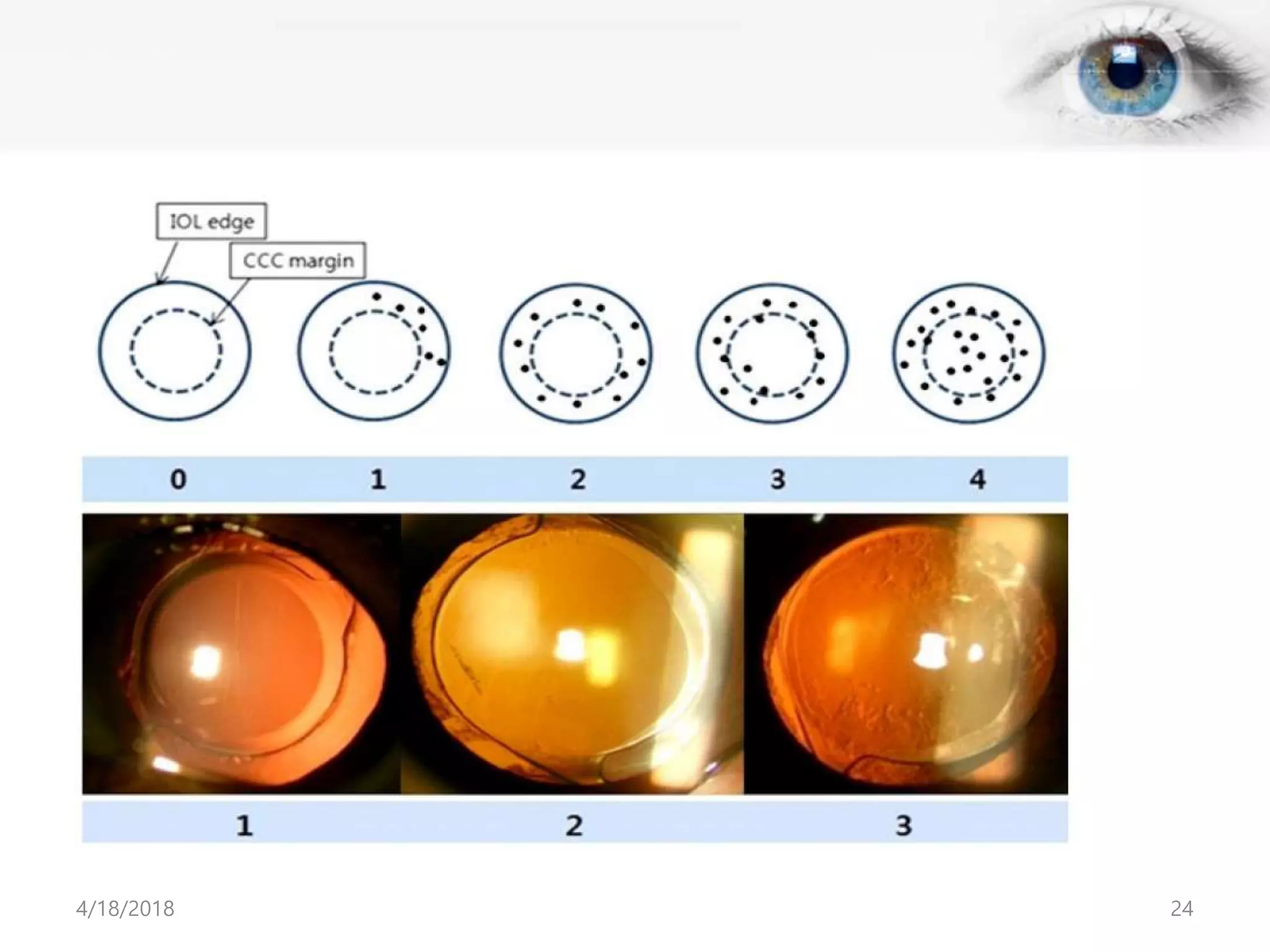 Posterior capsular opacification | PPTX