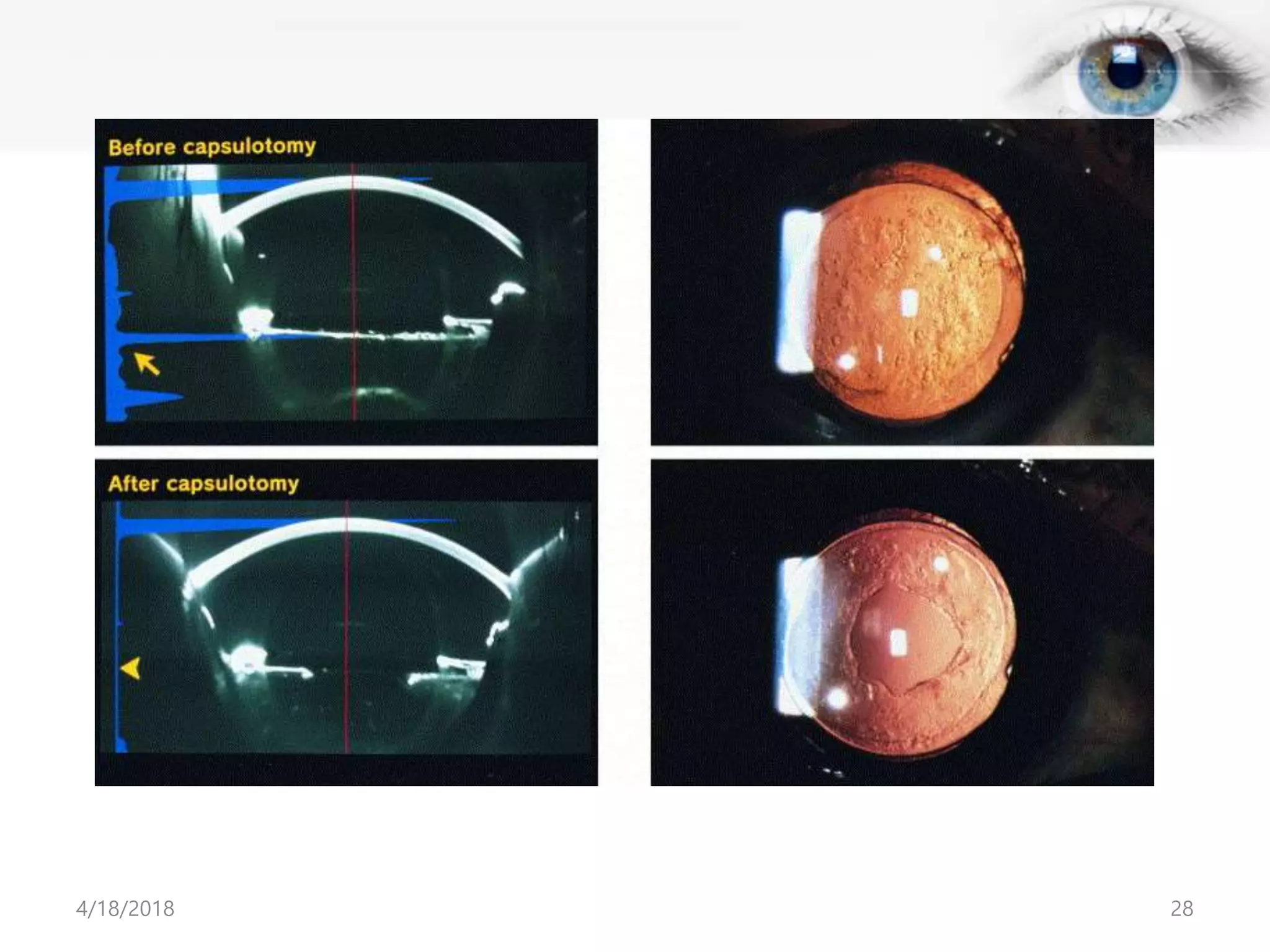 Posterior capsular opacification | PPTX