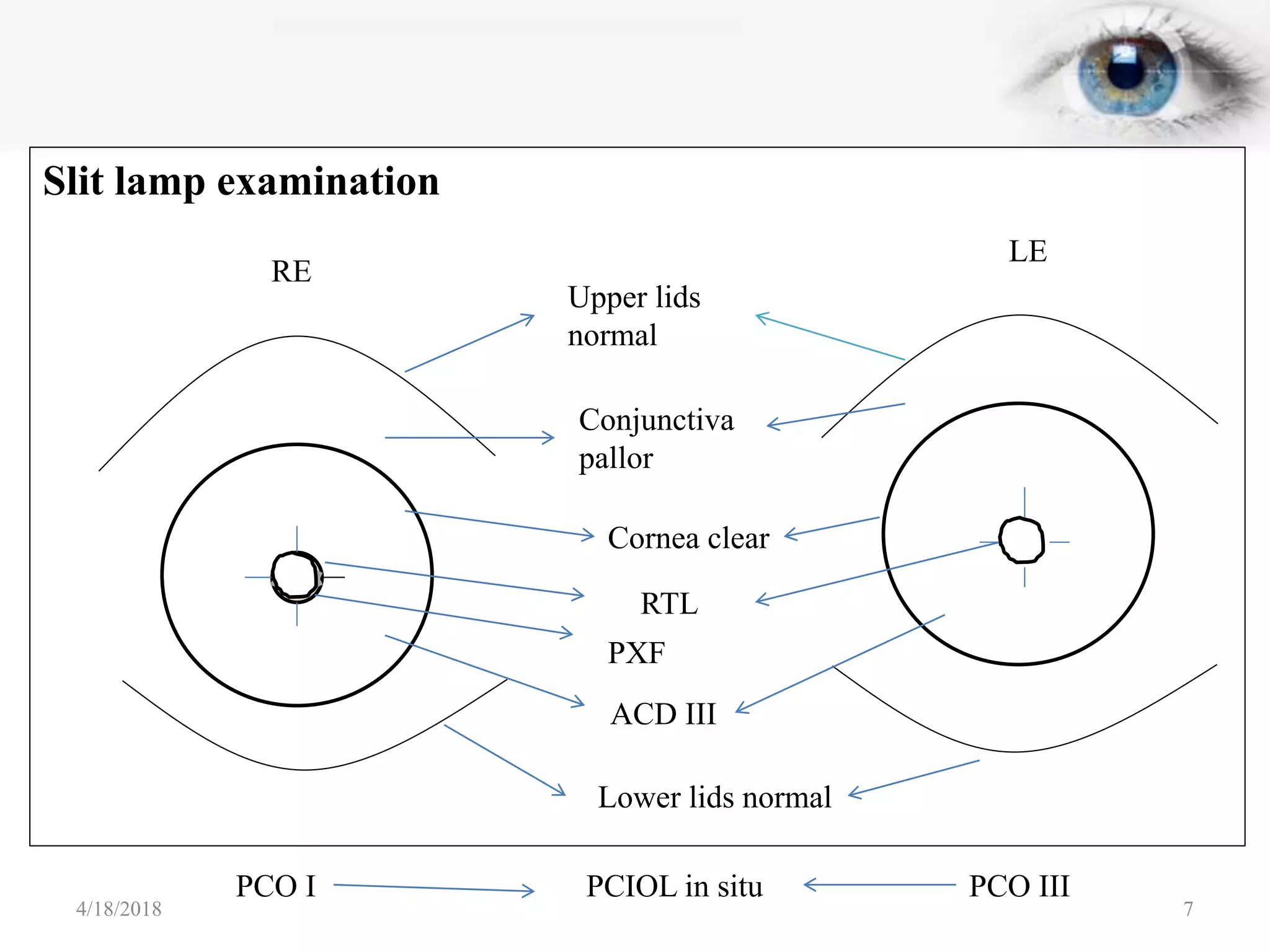 Posterior capsular opacification | PPTX