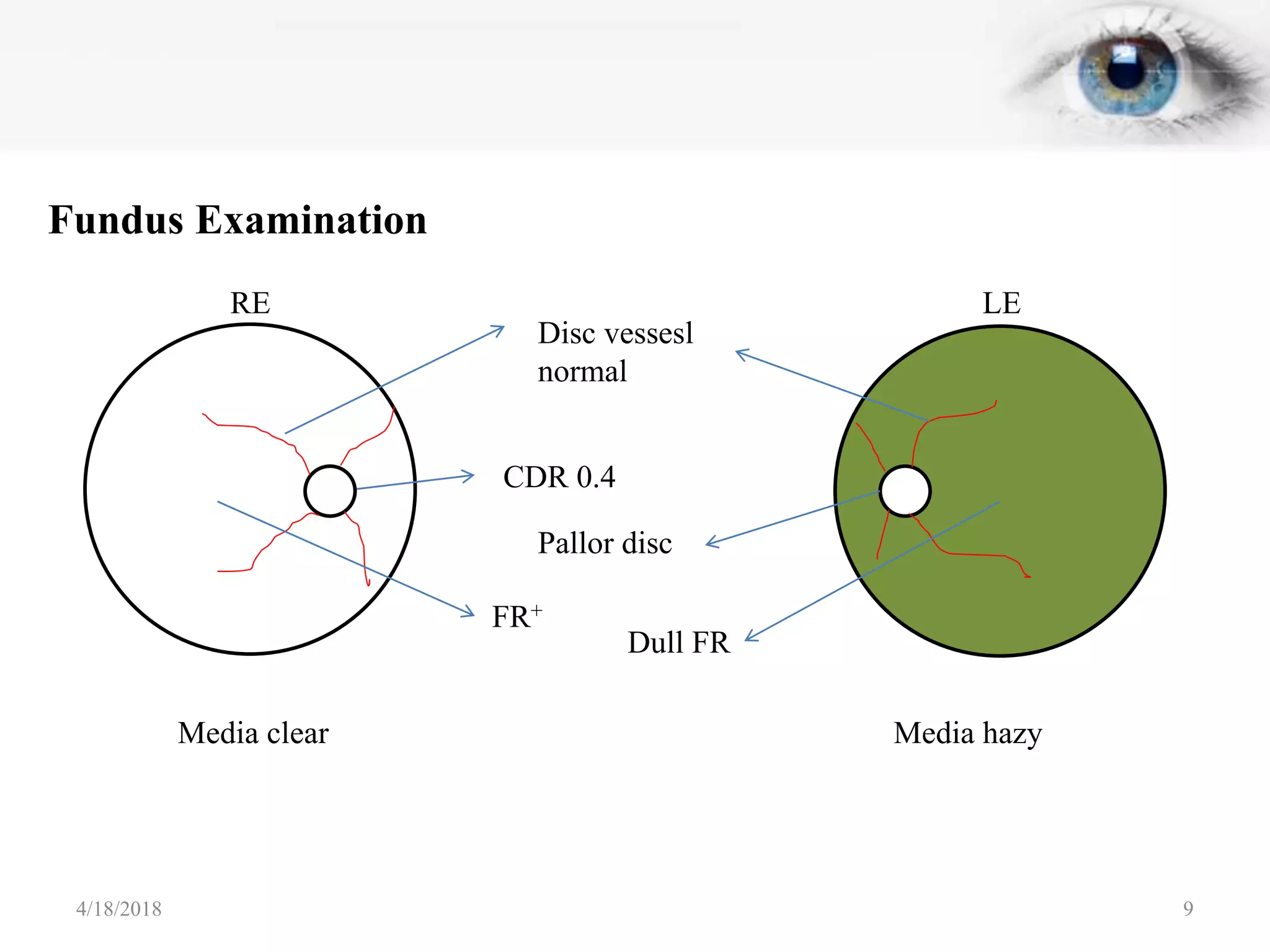 Posterior capsular opacification | PPTX