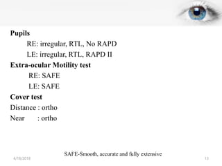 Posterior capsular opacification | PPTX