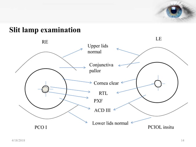 Posterior capsular opacification | PPTX | Eye and Vision Conditions ...