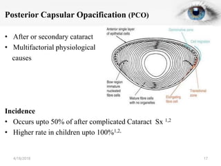 Posterior capsular opacification | PPTX | Eye and Vision Conditions ...