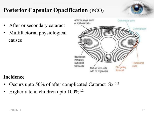 Posterior capsular opacification | PPTX | Eye and Vision Conditions ...
