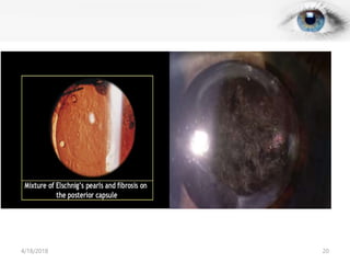 Posterior capsular opacification | PPTX