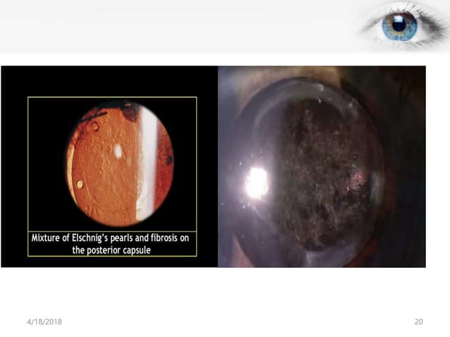 Posterior capsular opacification | PPTX | Eye and Vision Conditions ...