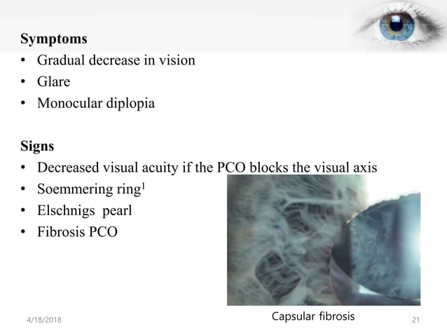 Posterior capsular opacification | PPTX | Eye and Vision Conditions ...