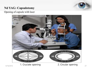 Posterior capsular opacification | PPTX