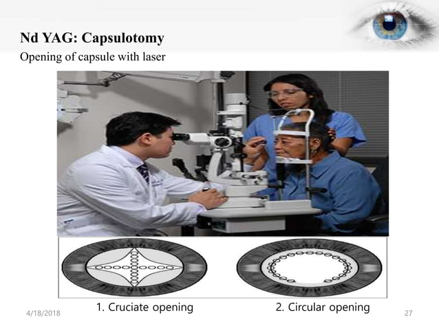 Posterior capsular opacification | PPTX | Eye and Vision Conditions ...