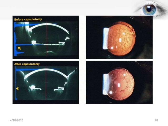 Posterior capsular opacification | PPTX | Eye and Vision Conditions ...