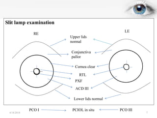 Posterior capsular opacification | PPTX