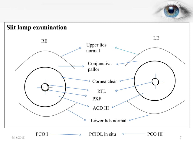 Posterior capsular opacification | PPTX | Eye and Vision Conditions ...