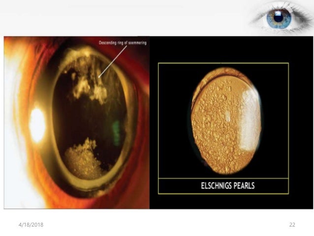 Posterior capsular opacification