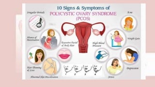 Polycystic ovarian Disease Causes & Prevention | PPTX