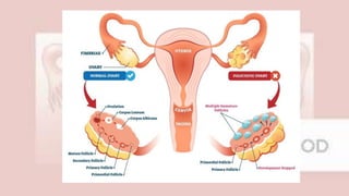 Polycystic ovarian Disease Causes & Prevention | PPTX