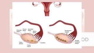 Polycystic ovarian Disease Causes & Prevention | PPTX