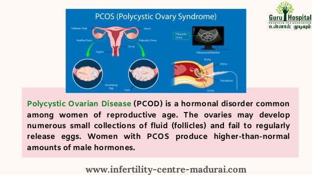 PCOD: Causes, Symptoms And Treatment
