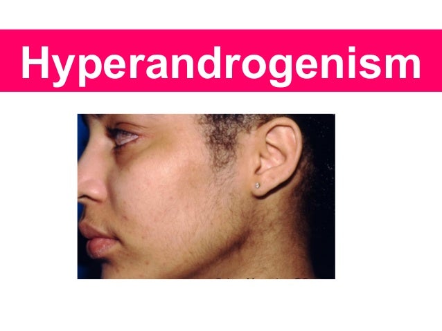 Polycystic Ovarian Disease & Hyperandrogenism Evidence Based Updat…