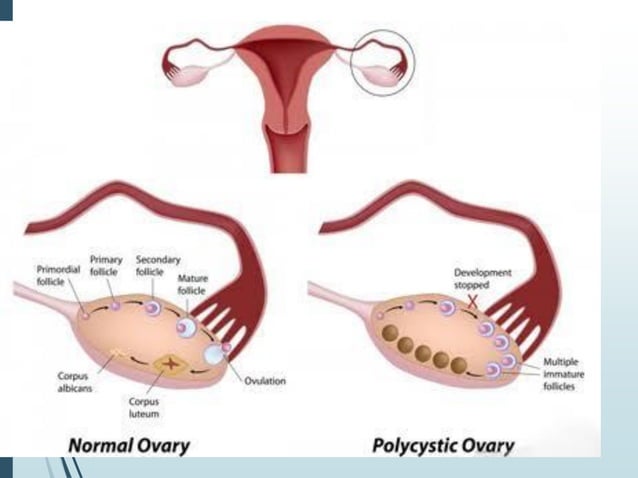 PCOD Details - A guide to learn more about PCOD | PDF | Hormonal Disorders | Endocrine and ...